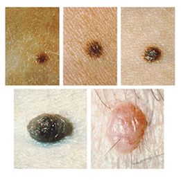 Abnormal moles