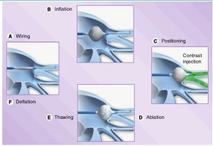 Types of ablation surgery