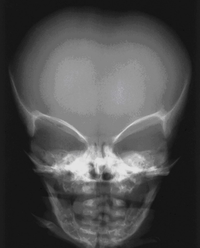 Achondroplasia symptoms
